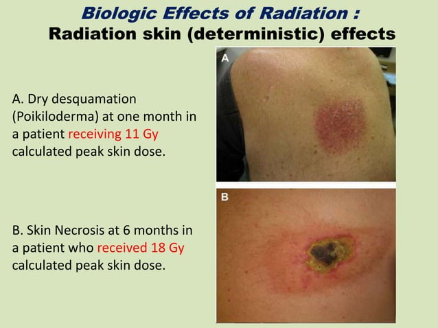 Radiation Safety In The Cath Lab | PPTX