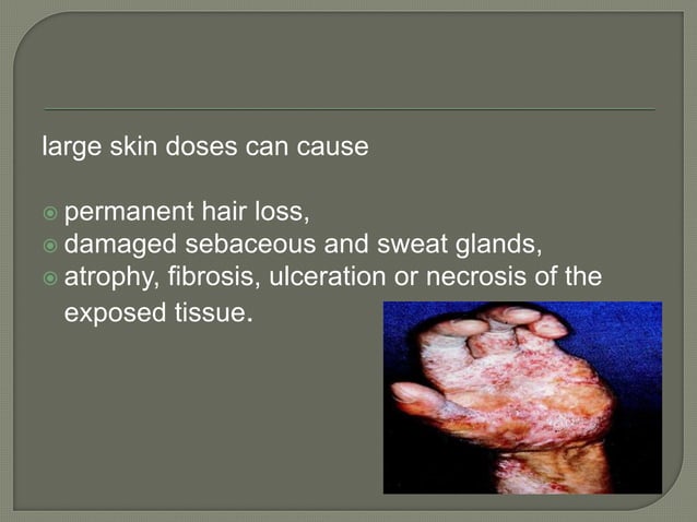 Radiation sickness | PPTX