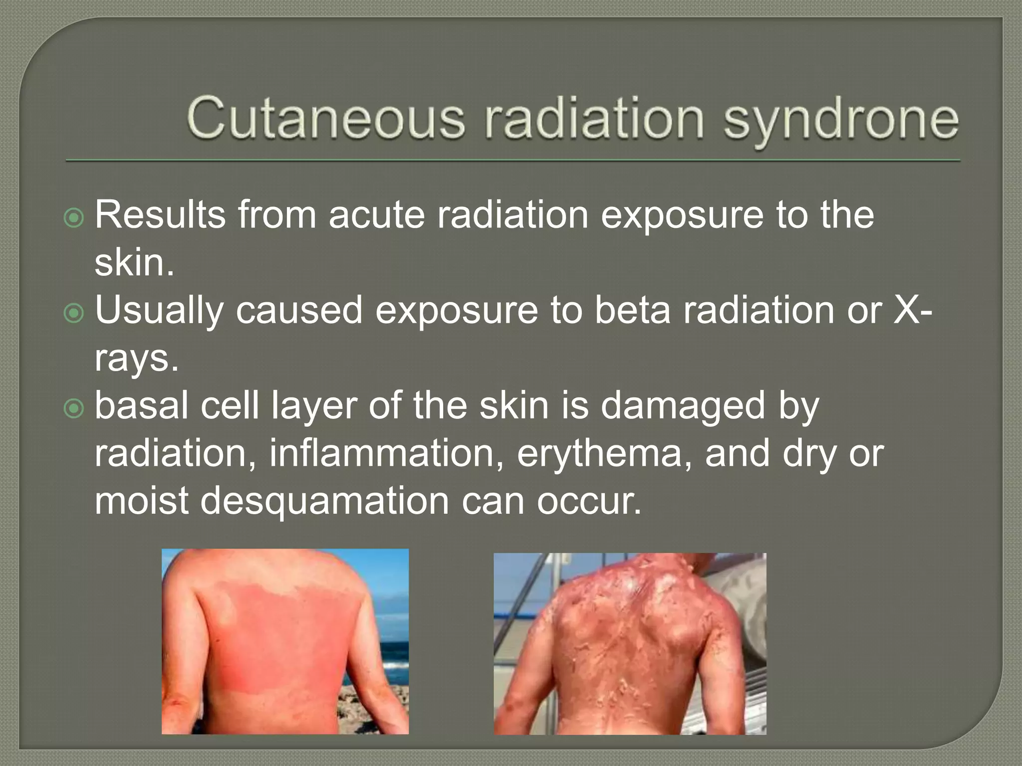 Radiation sickness - Acute and Chronic | PPTX