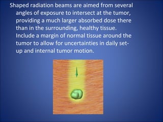 Radiation therapy | PPT