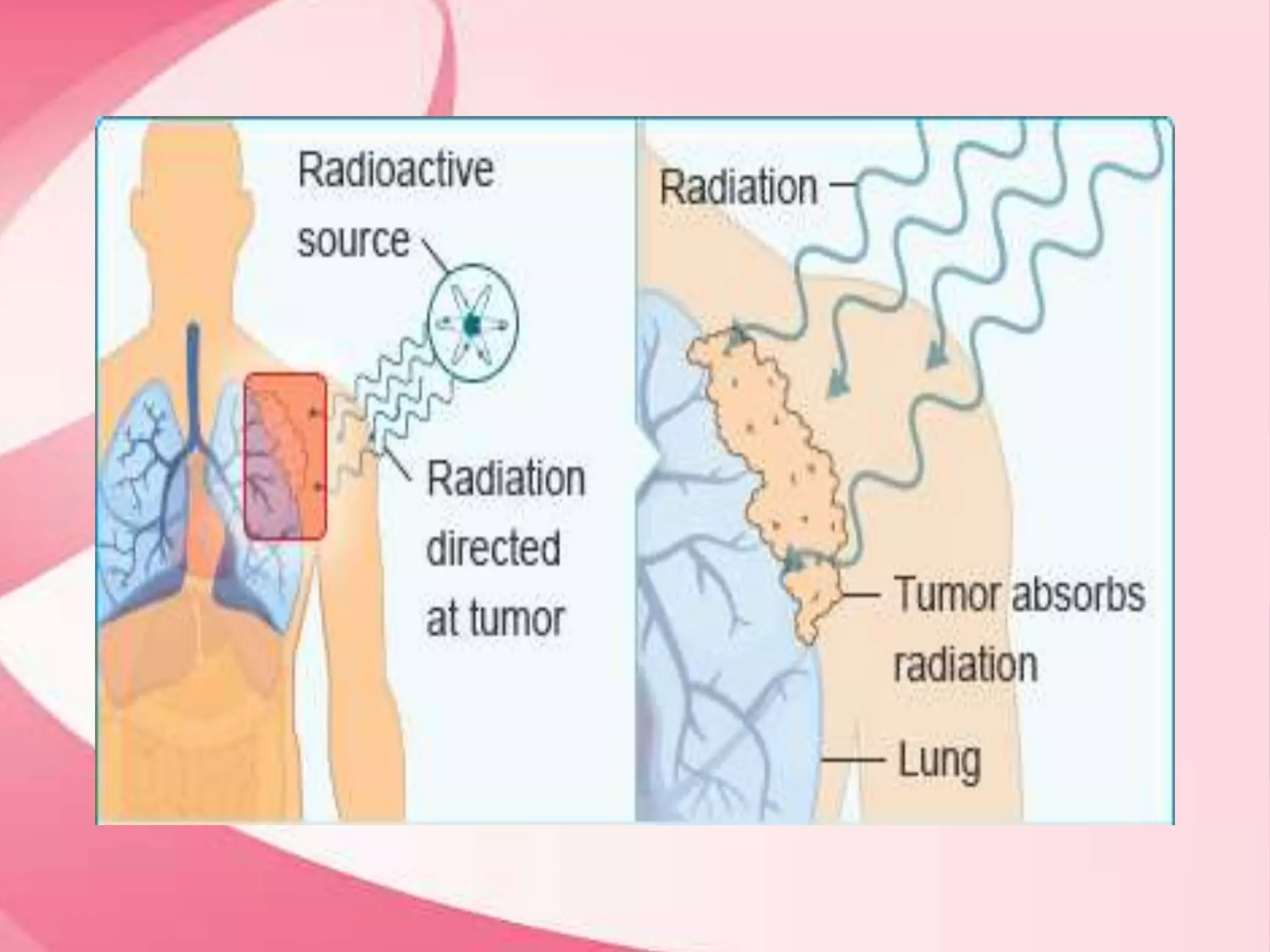 Radiation therapy for lung cancer | PPTX