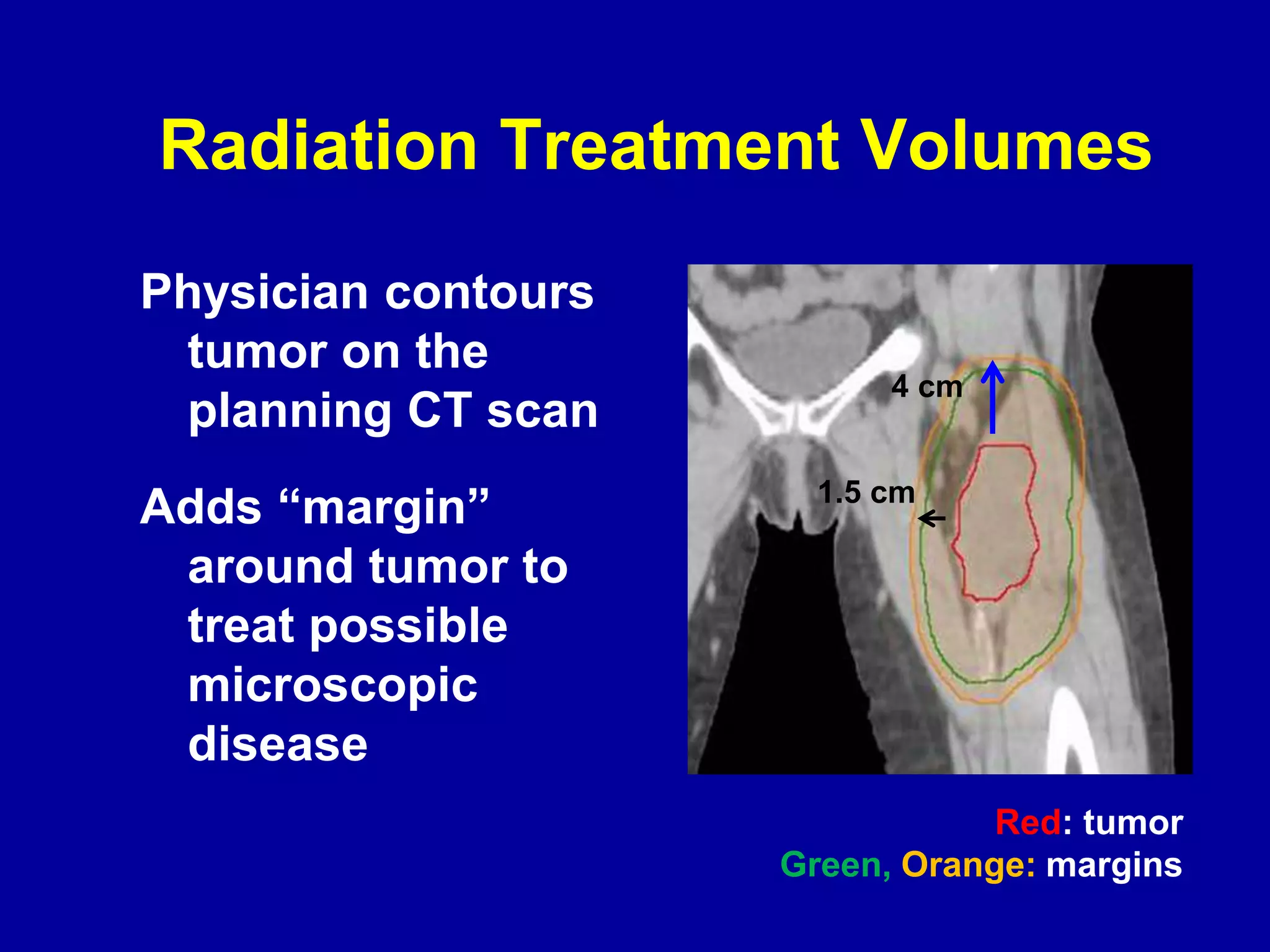 How Radiation Therapy is Used to Treat Soft Tissue Sarcoma | PPTX