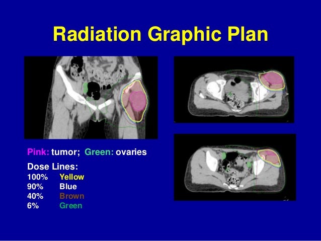How Radiation Therapy is Used to Treat Soft Tissue Sarcoma