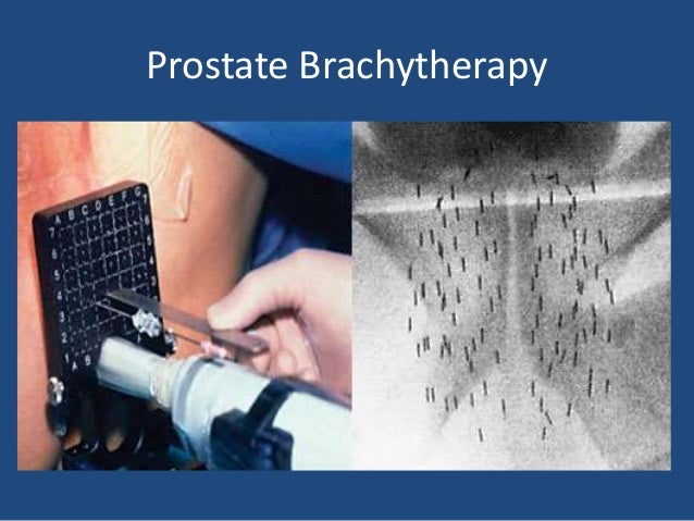 Radiation therapy in prostate cancer