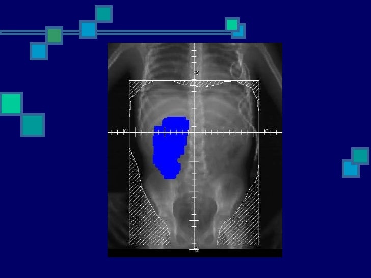 Radiation therapy in wilms tumour