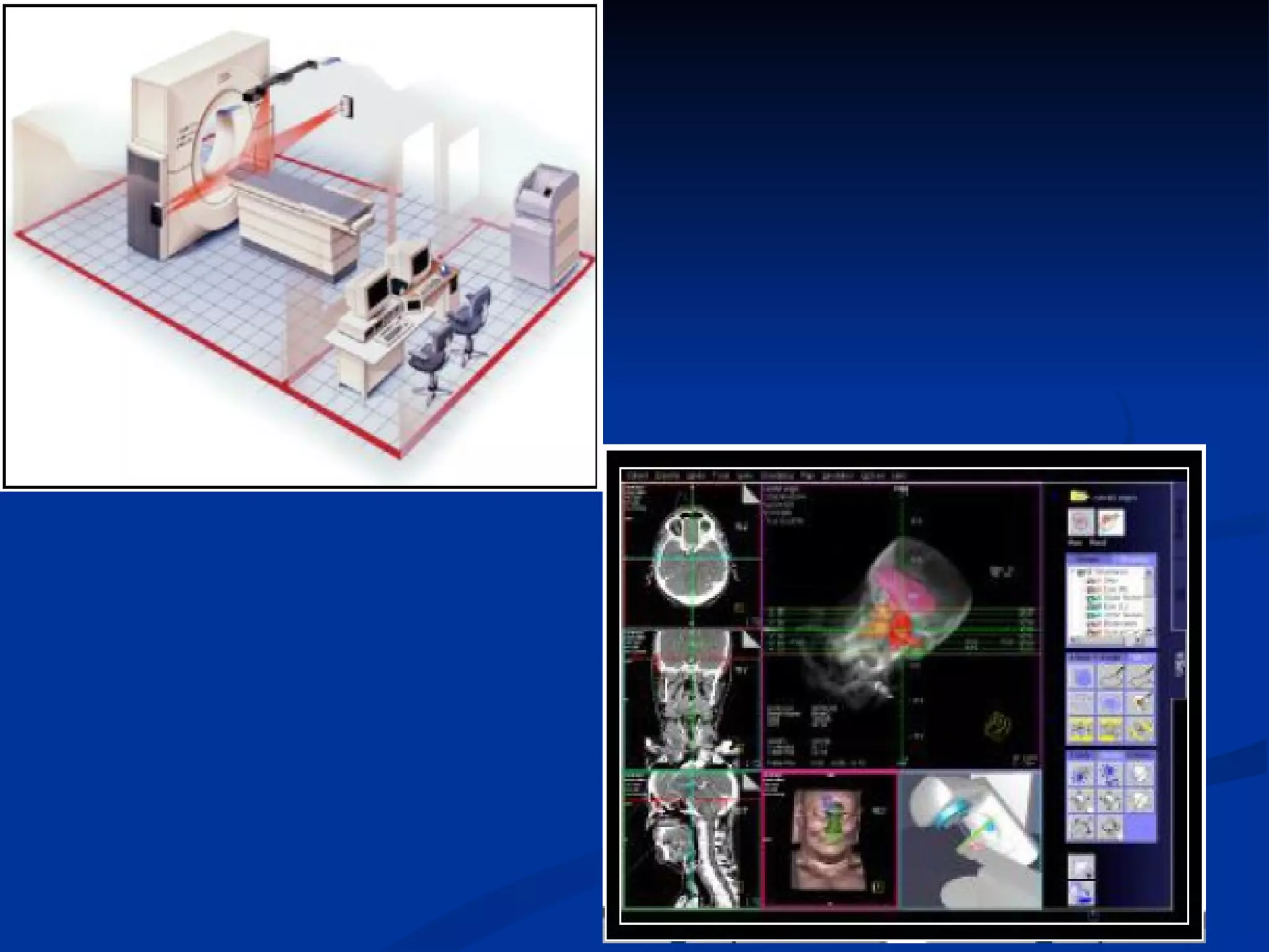 Radiation therapy of oral cancers | PPT