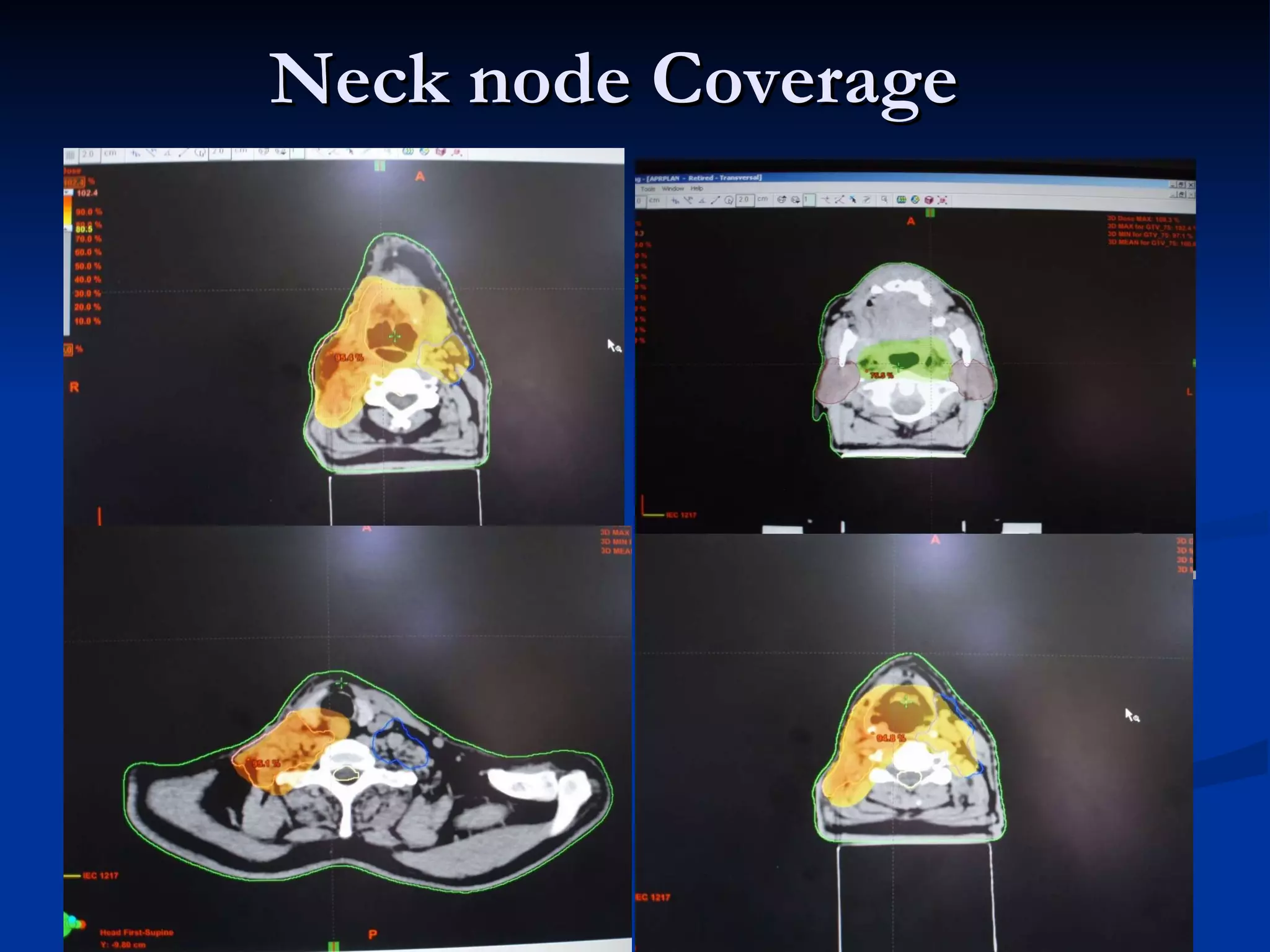 Radiation therapy of oral cancers | PPT