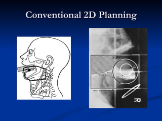 Radiation therapy of oral cancers | PPT