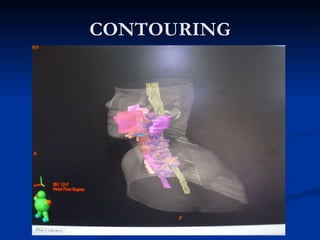 Radiation therapy of oral cancers | PPT
