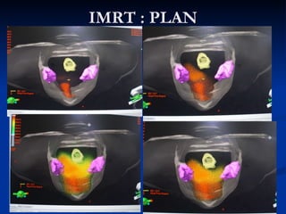 Radiation therapy of oral cancers | PPT