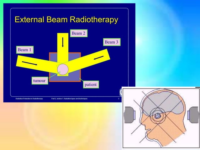 Radiation therapy omfs | PPTX