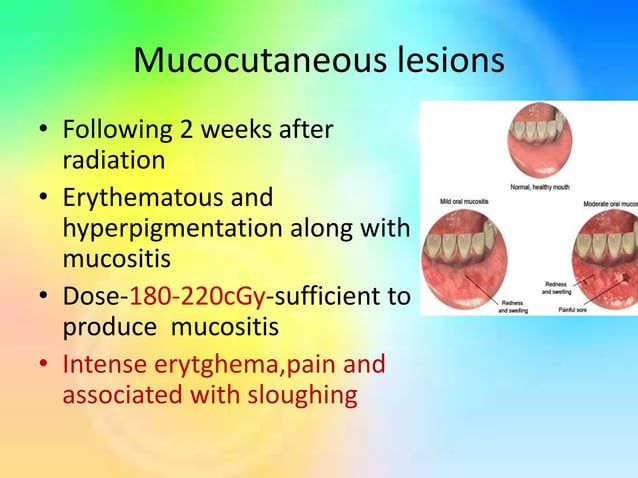 Radiation therapy omfs | PPTX