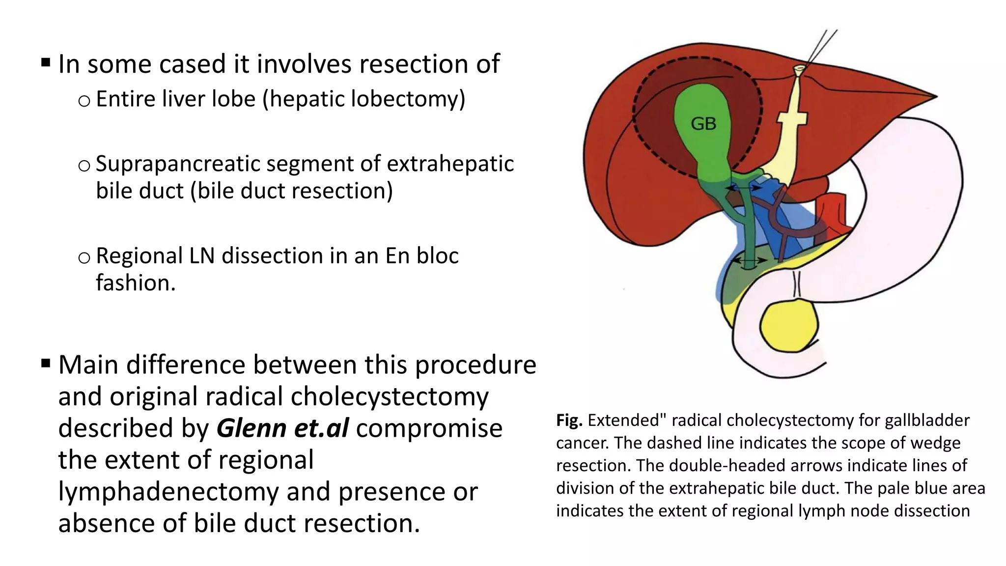 Radical Cholecystectomy.pptx
