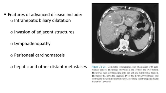 Radical Cholecystectomy.pptx | Digestive Disorders | Diseases and ...