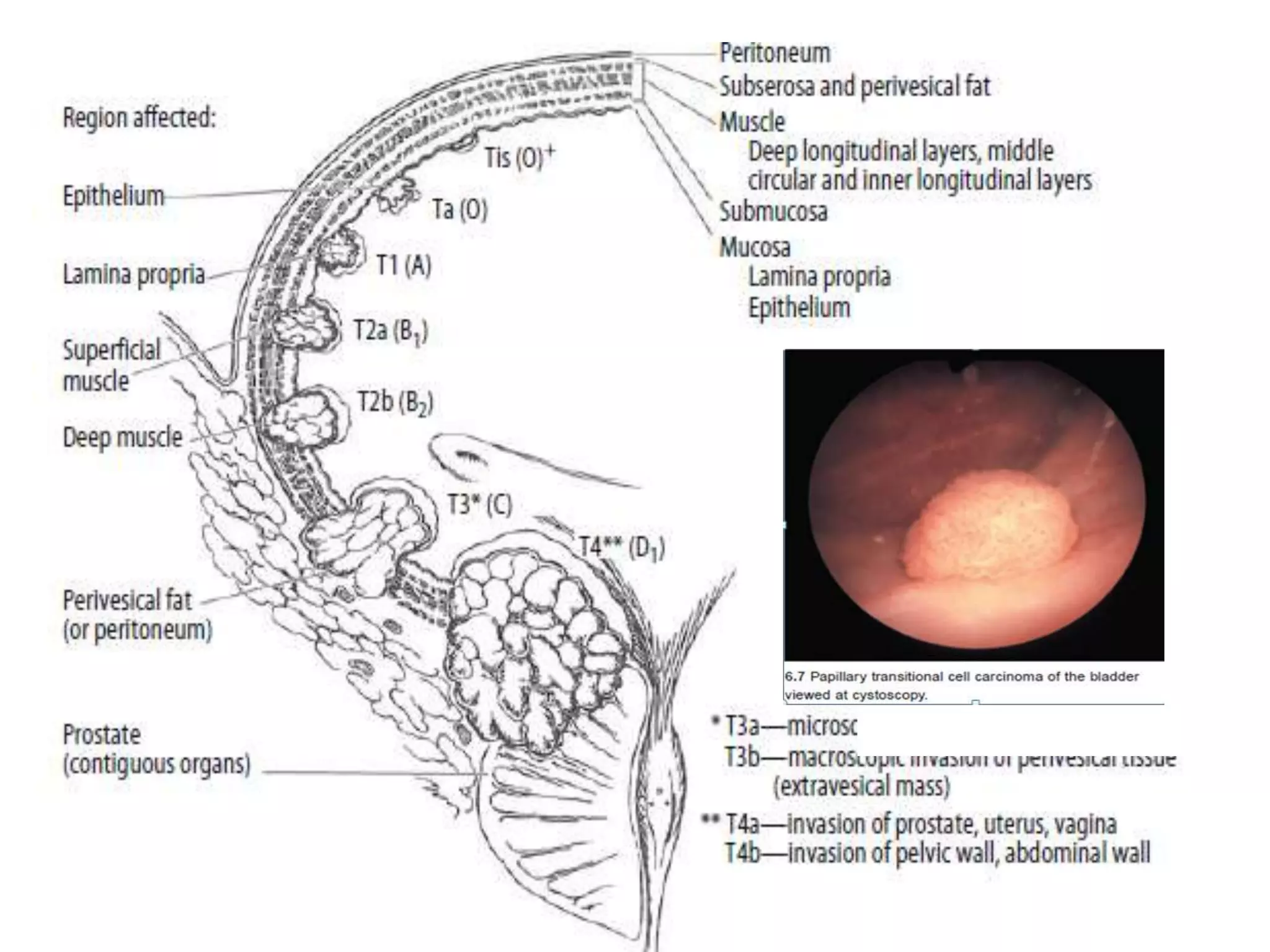 Radical cystectomy | PPTX