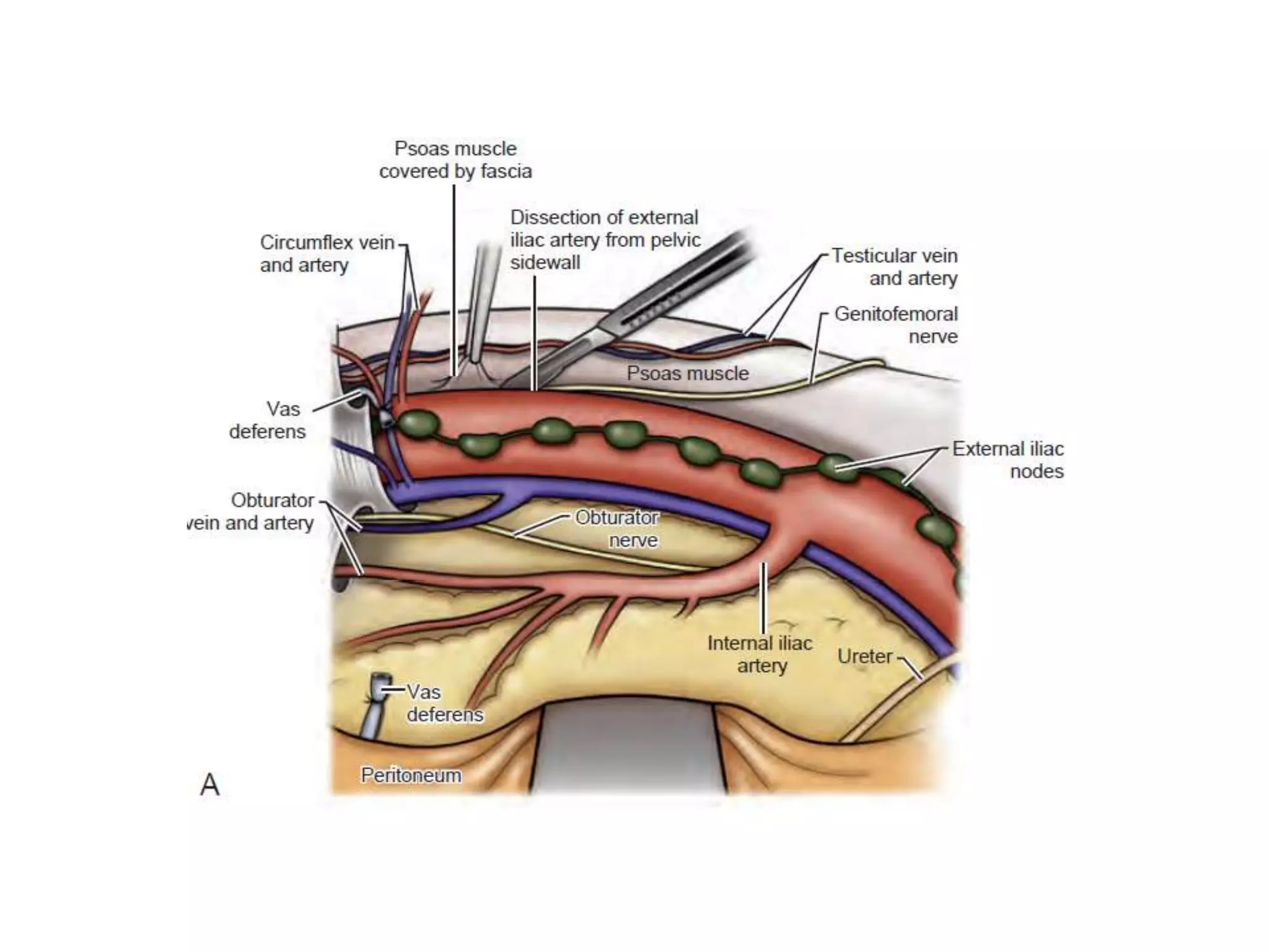 Radical cystectomy | PPT