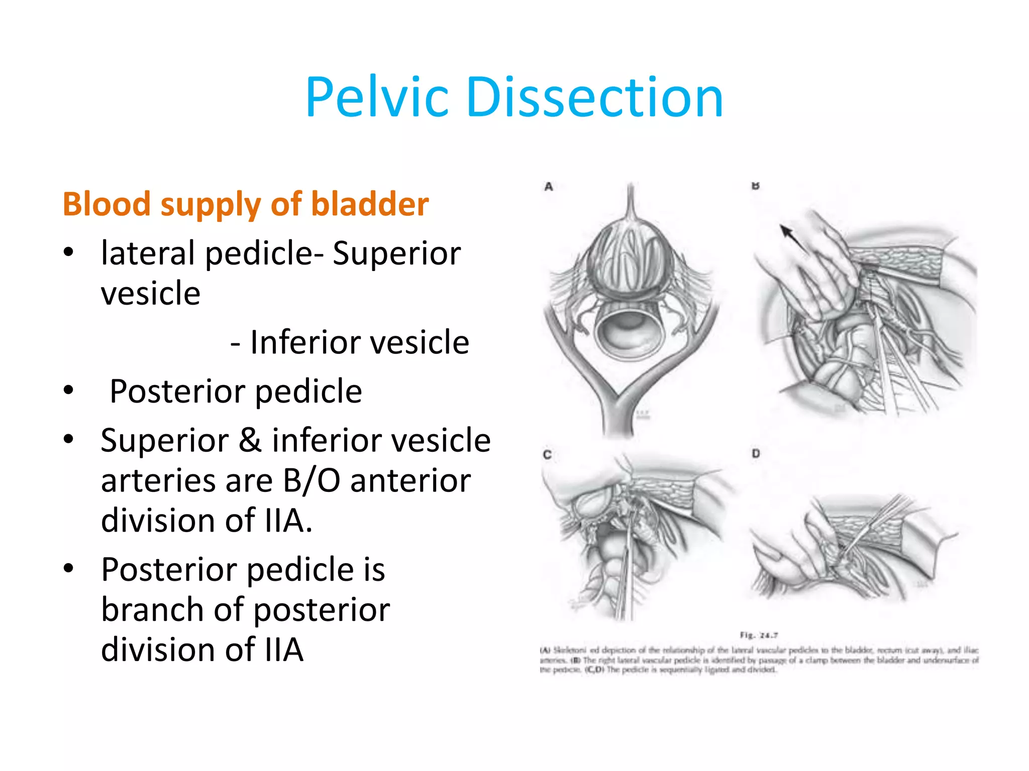 Radical cystectomy | PPTX