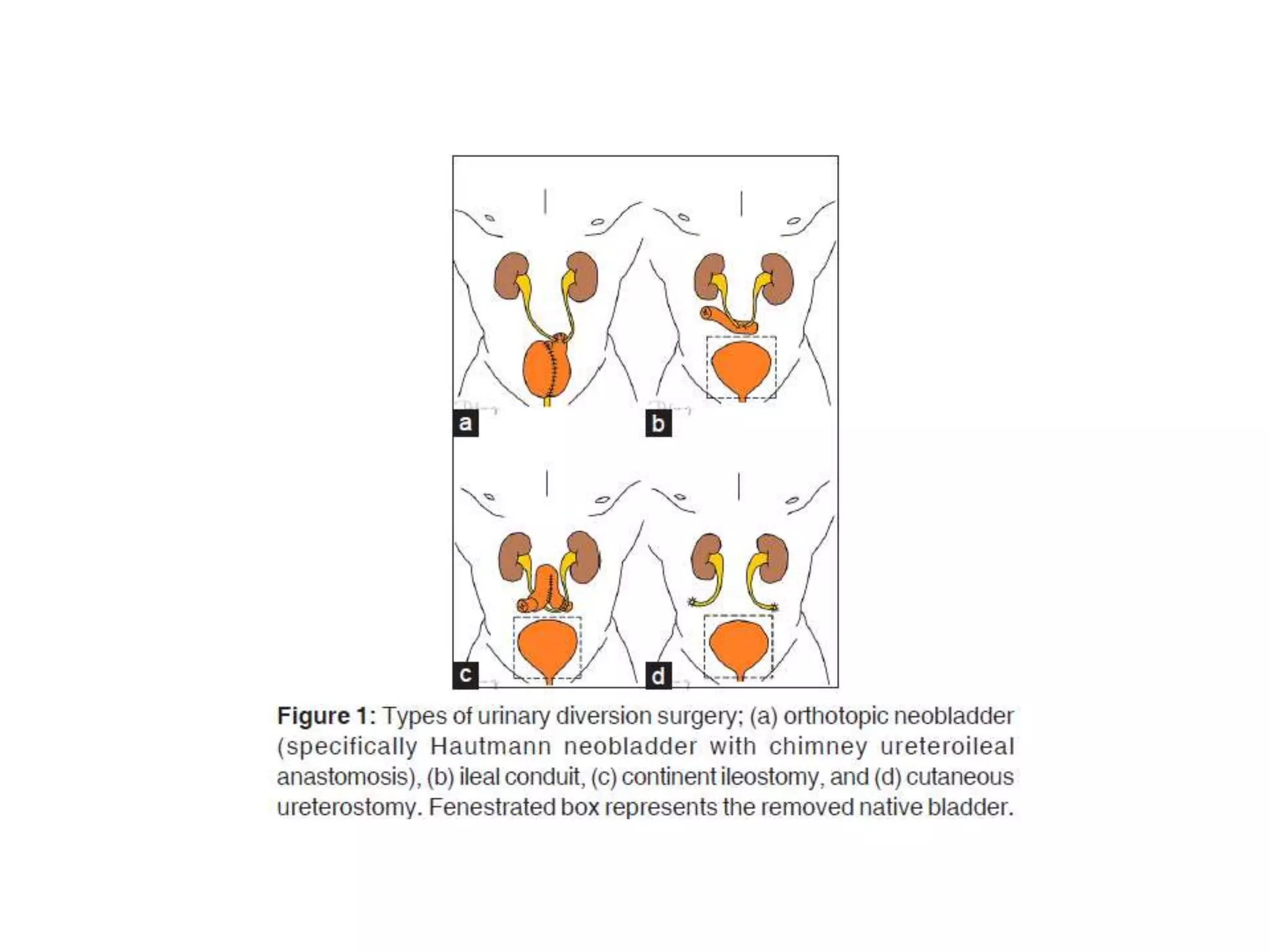 Radical cystectomy | PPTX