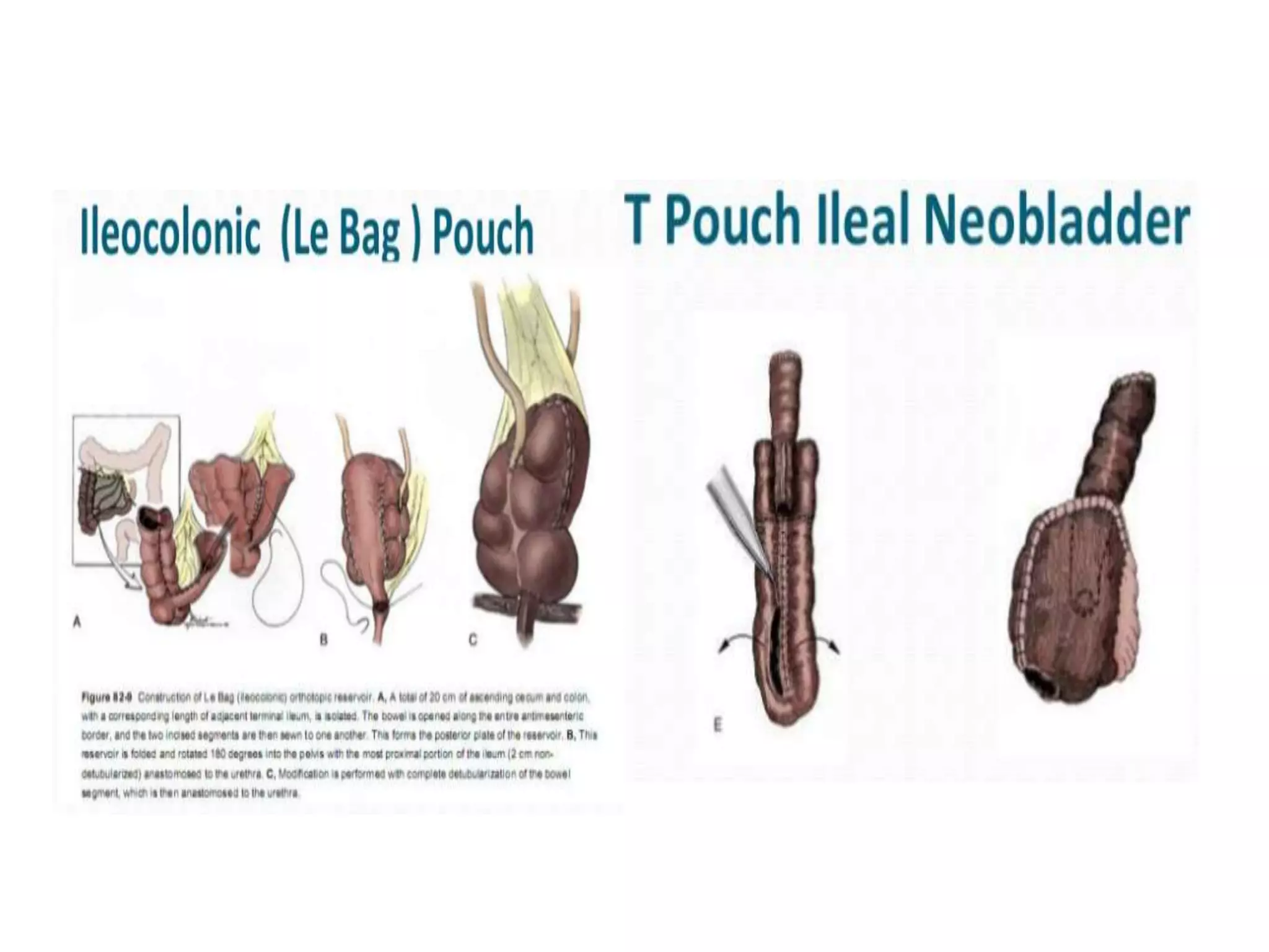 Radical cystectomy | PPTX