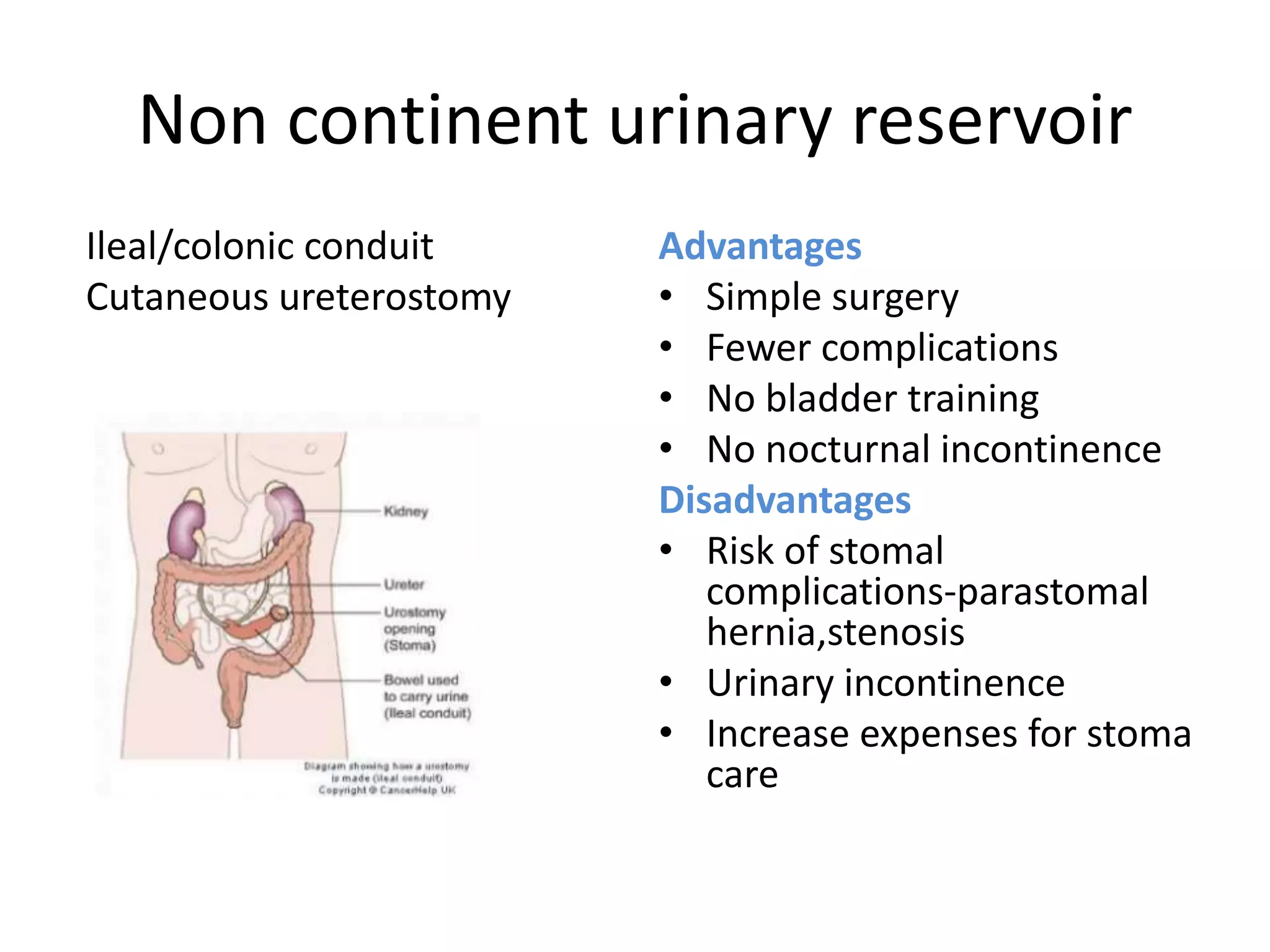 Radical cystectomy | PPTX
