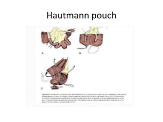 Radical cystectomy | PPTX | Cancer | Diseases and Conditions