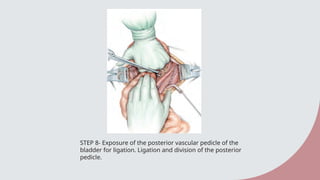 Radical cystectomy for carcinoma bladder | PPTX