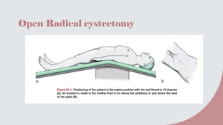 Radical cystectomy for carcinoma bladder | PPTX