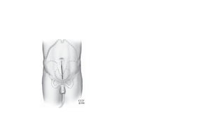 Radical Cystectomy for muscle invasive bladder cancer.pptx