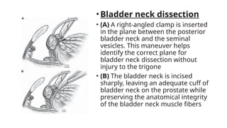 Radical Cystectomy for muscle invasive bladder cancer.pptx
