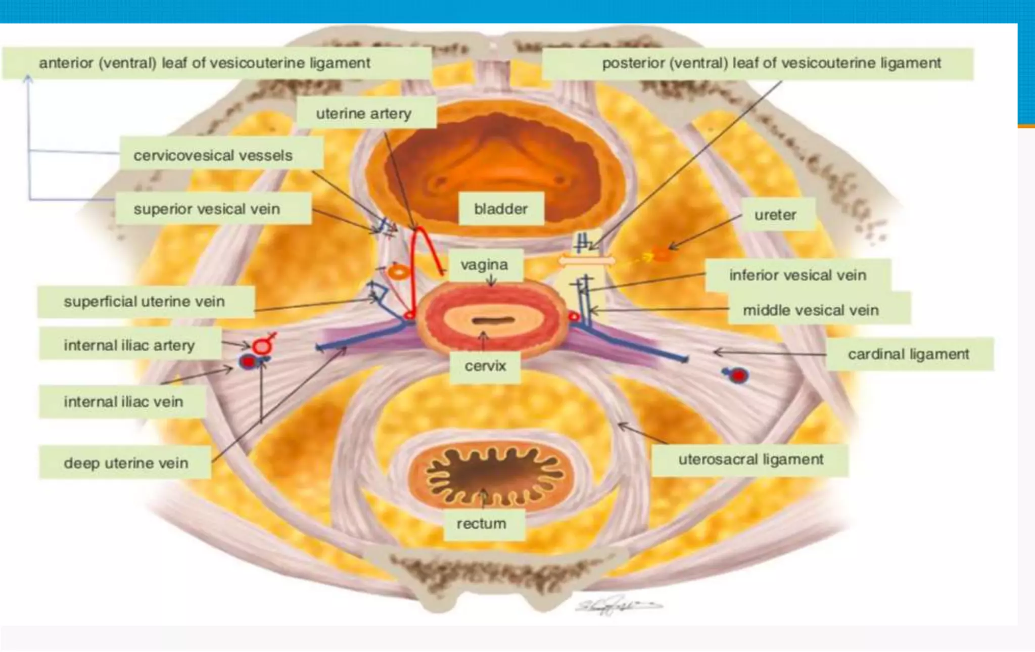 Radical hysterectomy | PPT