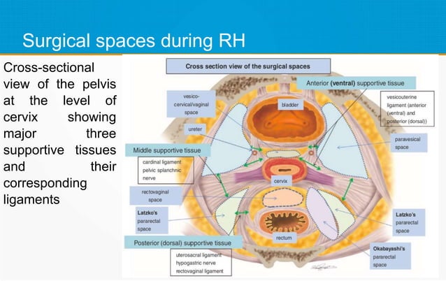 Radical hysterectomy | PPT | Reproductive Health | Diseases and Conditions