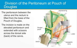 Radical hysterectomy | PPT