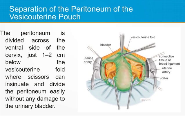 Radical hysterectomy | PPT | Reproductive Health | Diseases and Conditions