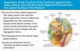 Radical hysterectomy | PPT