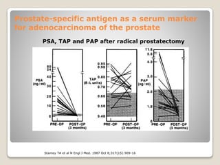 Radical prostatectomy in high serum psa values a surgical expertise ...