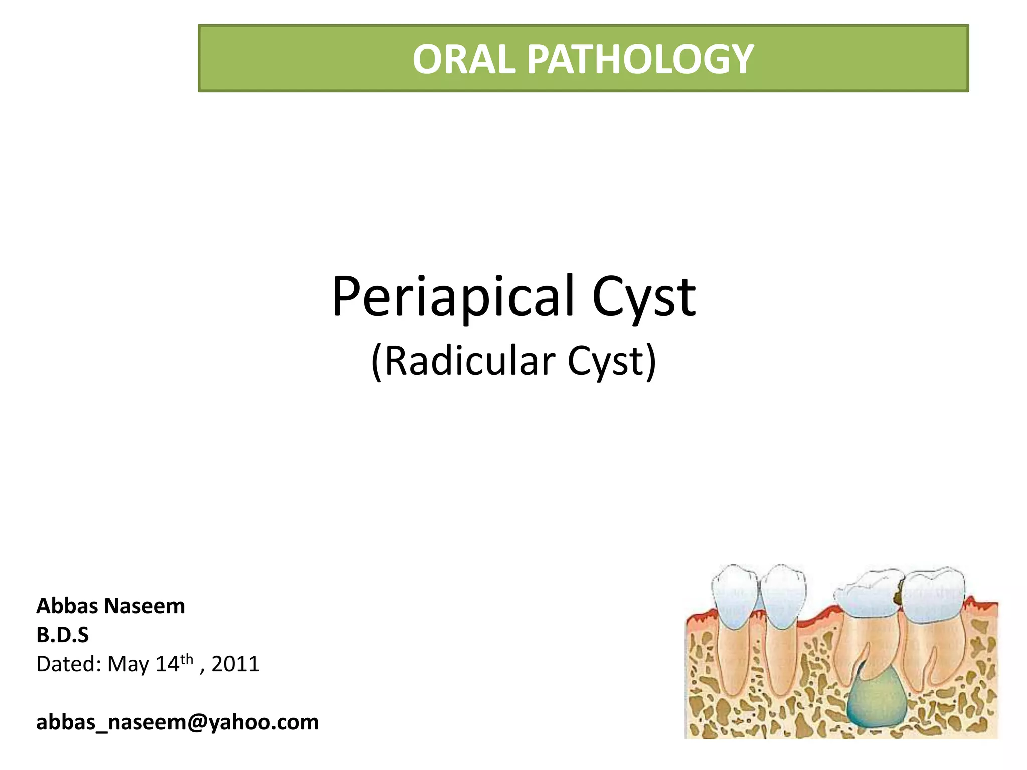 Radicular cyst or Periapical cyst | PPTX