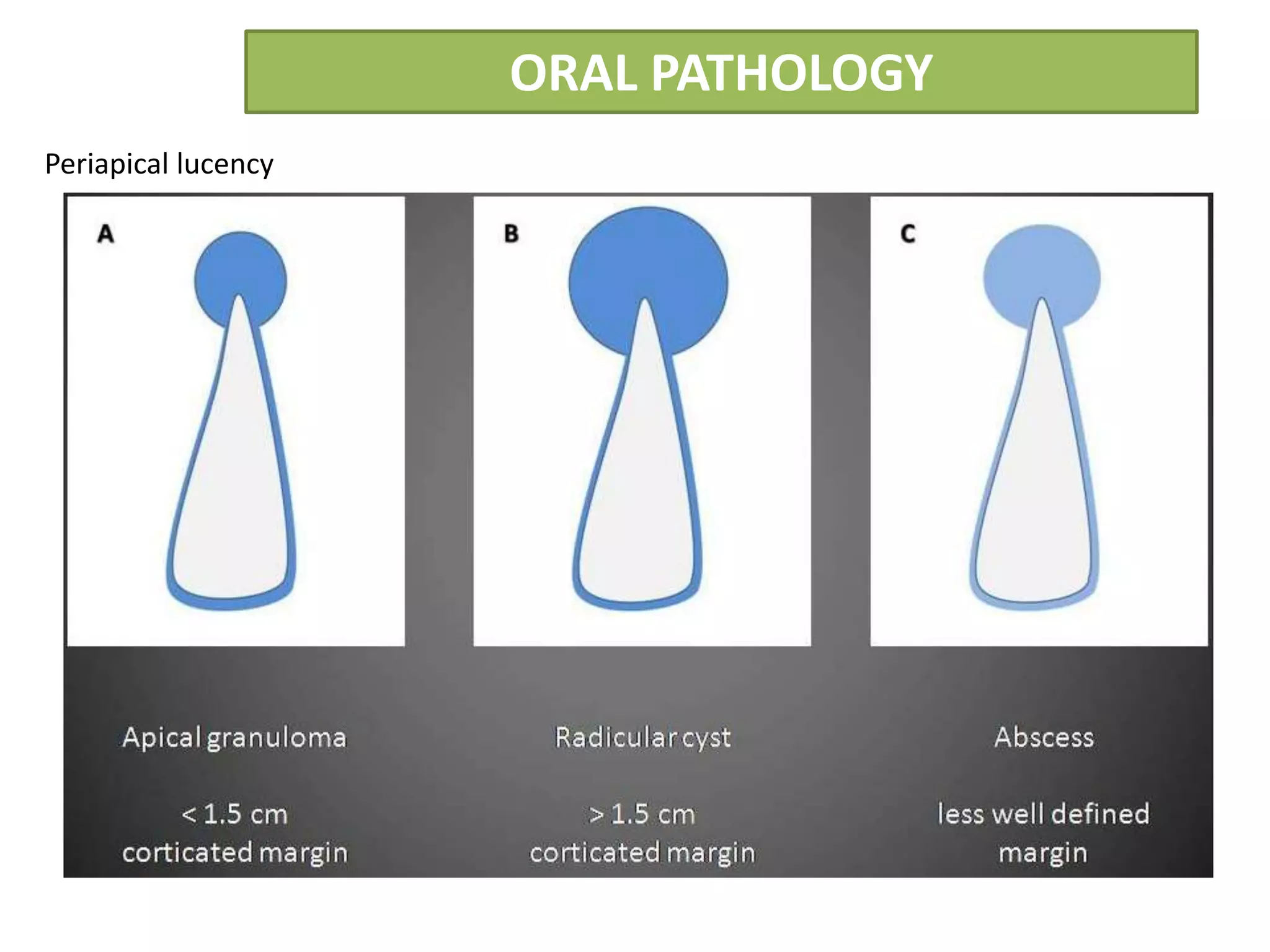 Radicular cyst or Periapical cyst | PPTX
