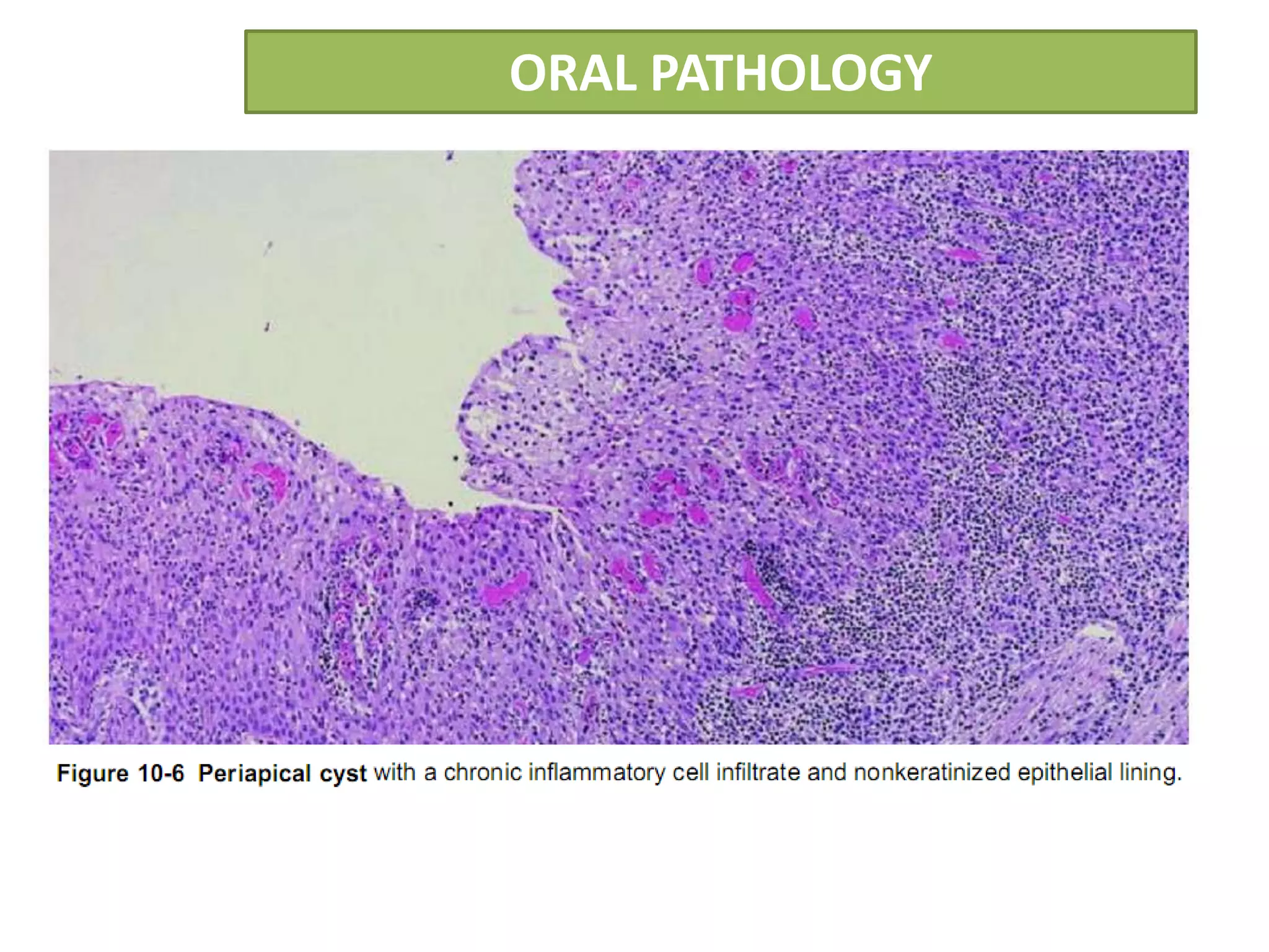 Radicular cyst or Periapical cyst | PPTX