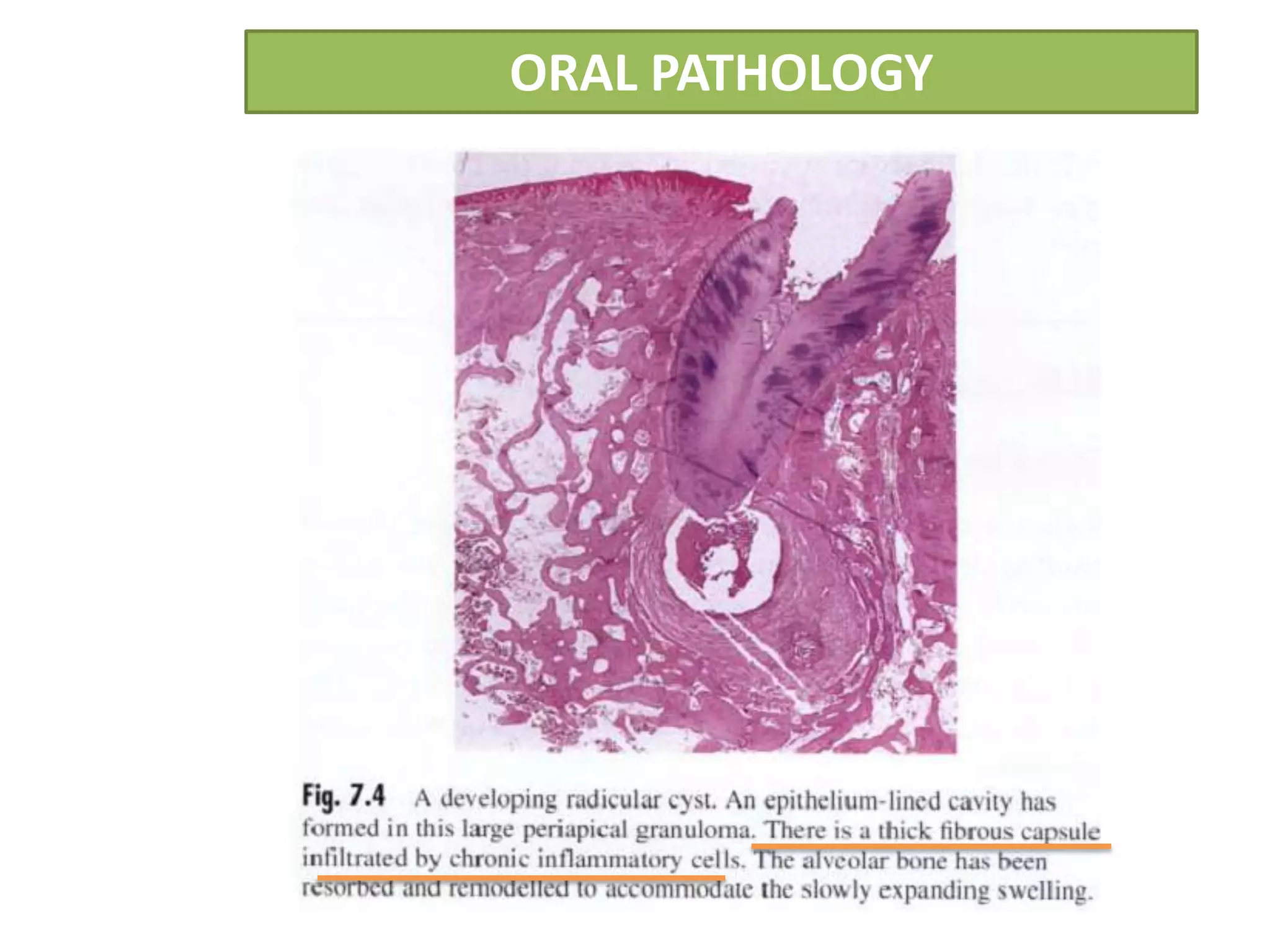 Radicular cyst or Periapical cyst | PPTX