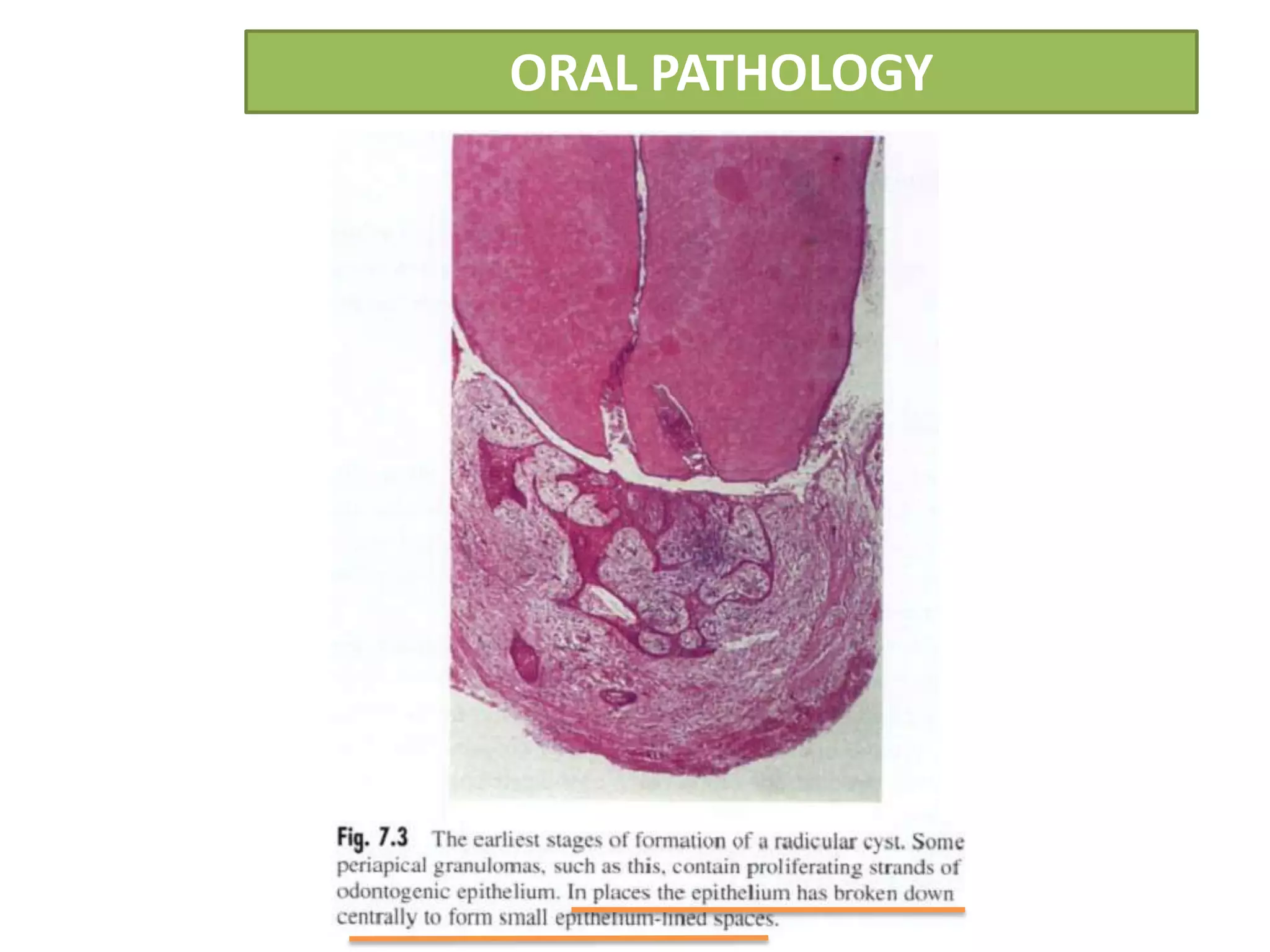 Radicular cyst or Periapical cyst | PPTX