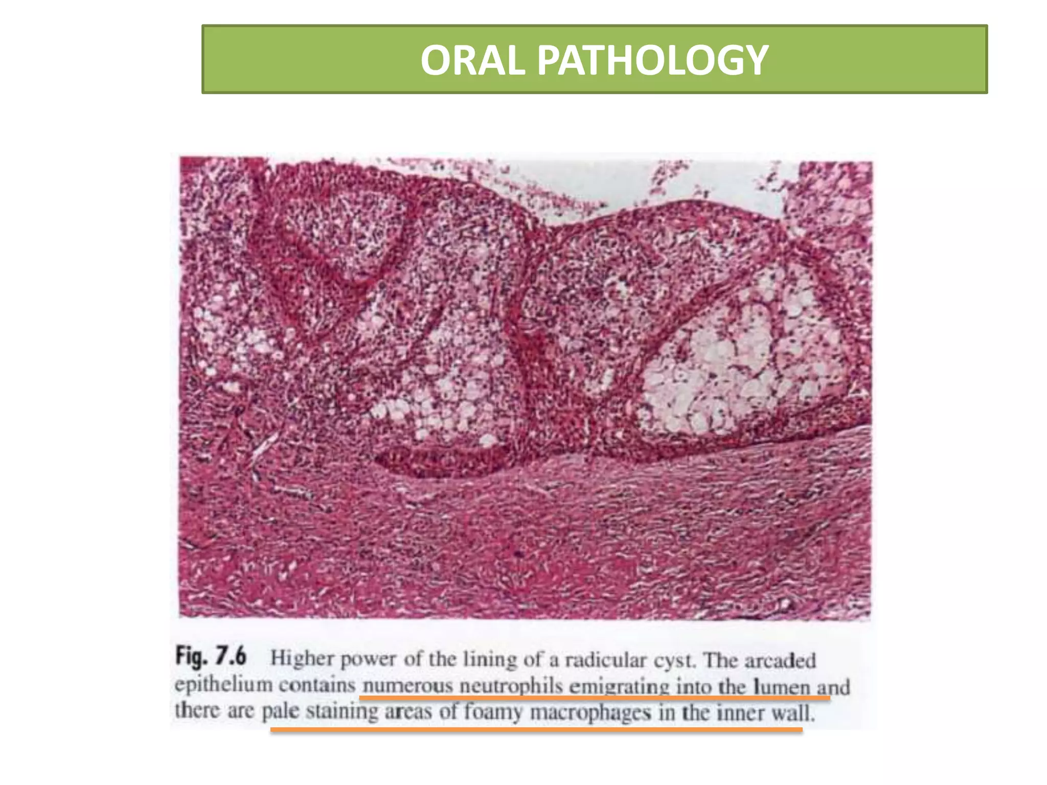 Radicular cyst or Periapical cyst | PPTX