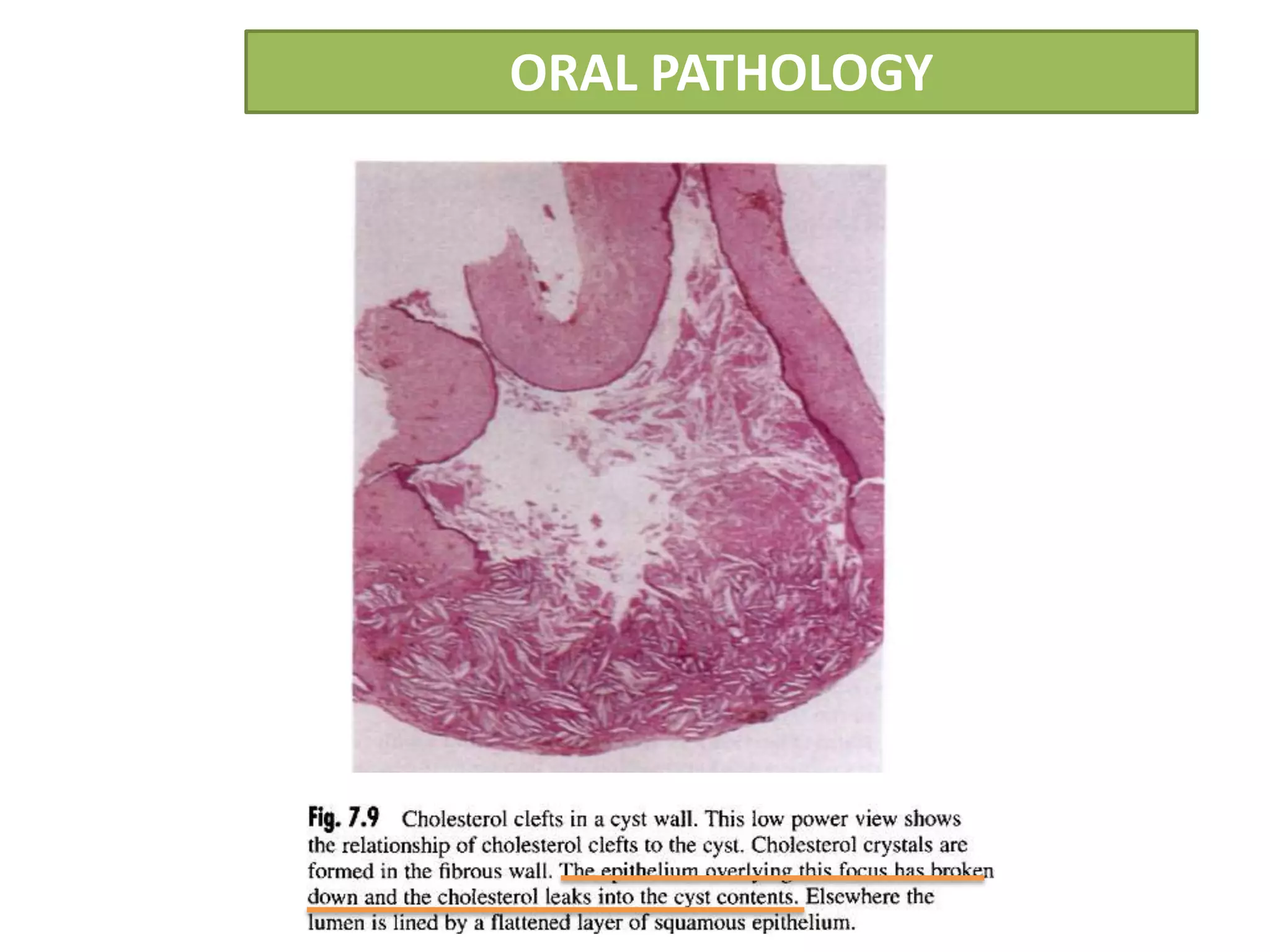 Radicular cyst or Periapical cyst | PPTX