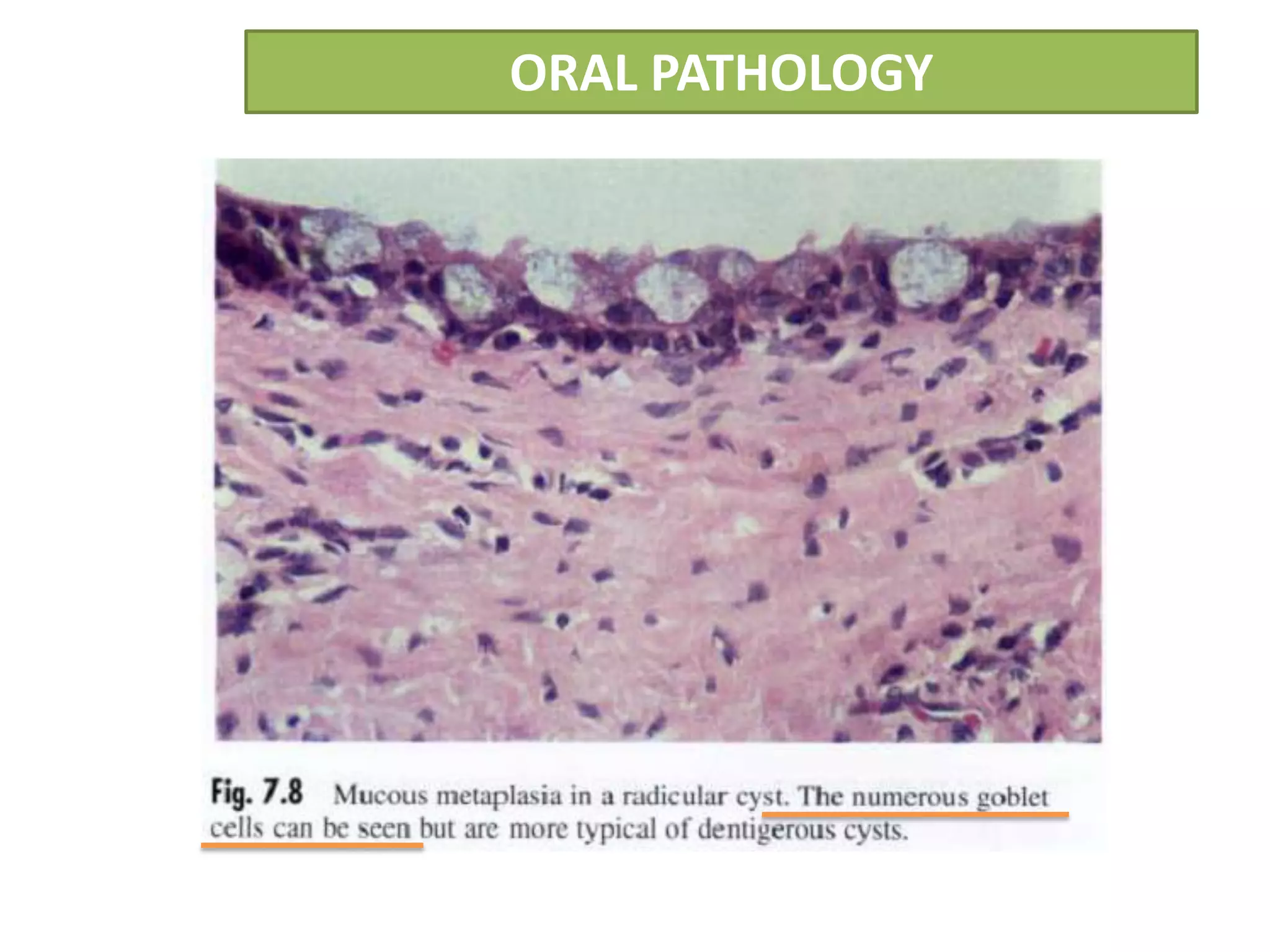 Radicular cyst or Periapical cyst | PPTX