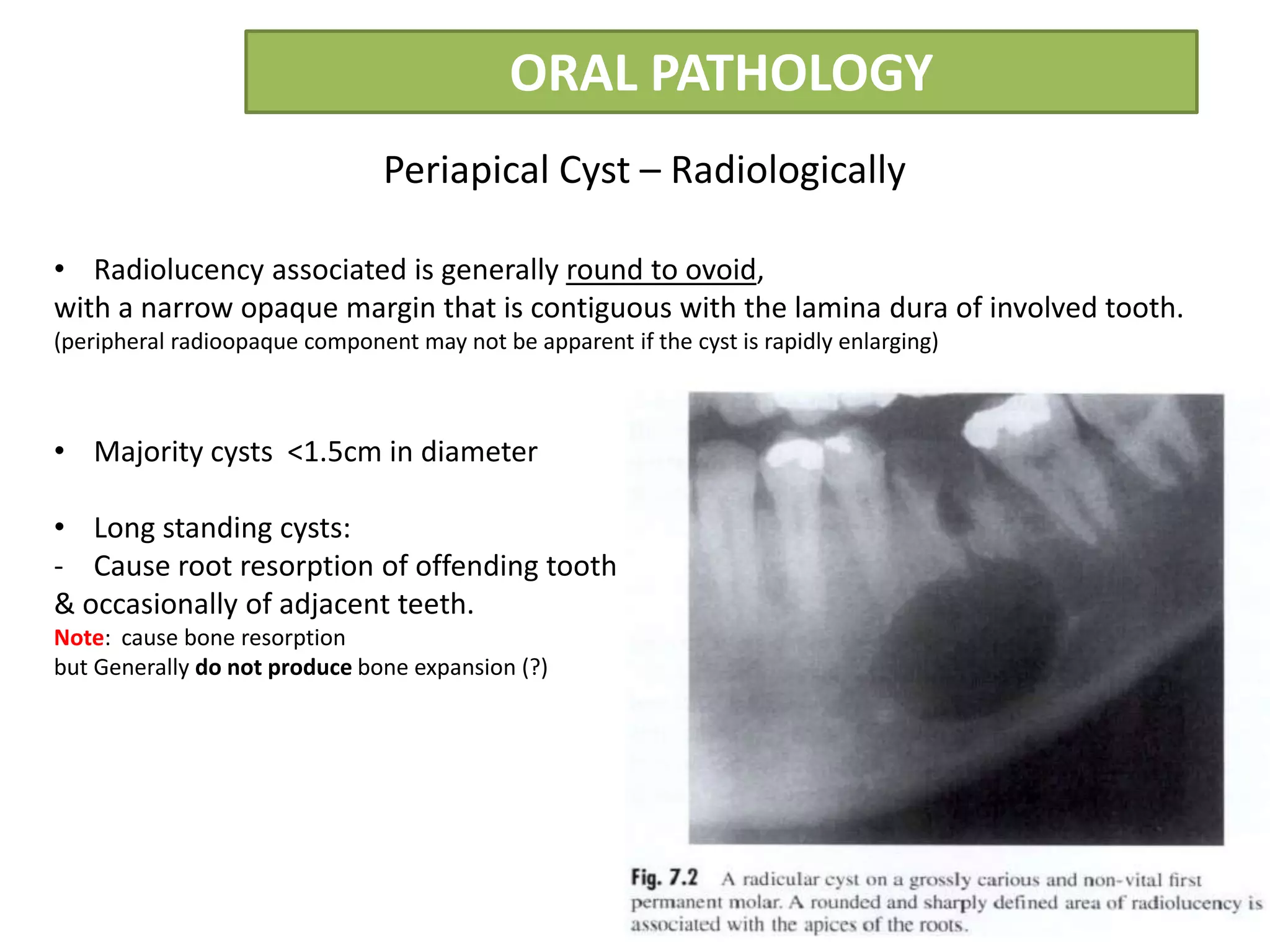 Radicular cyst or Periapical cyst | PPTX