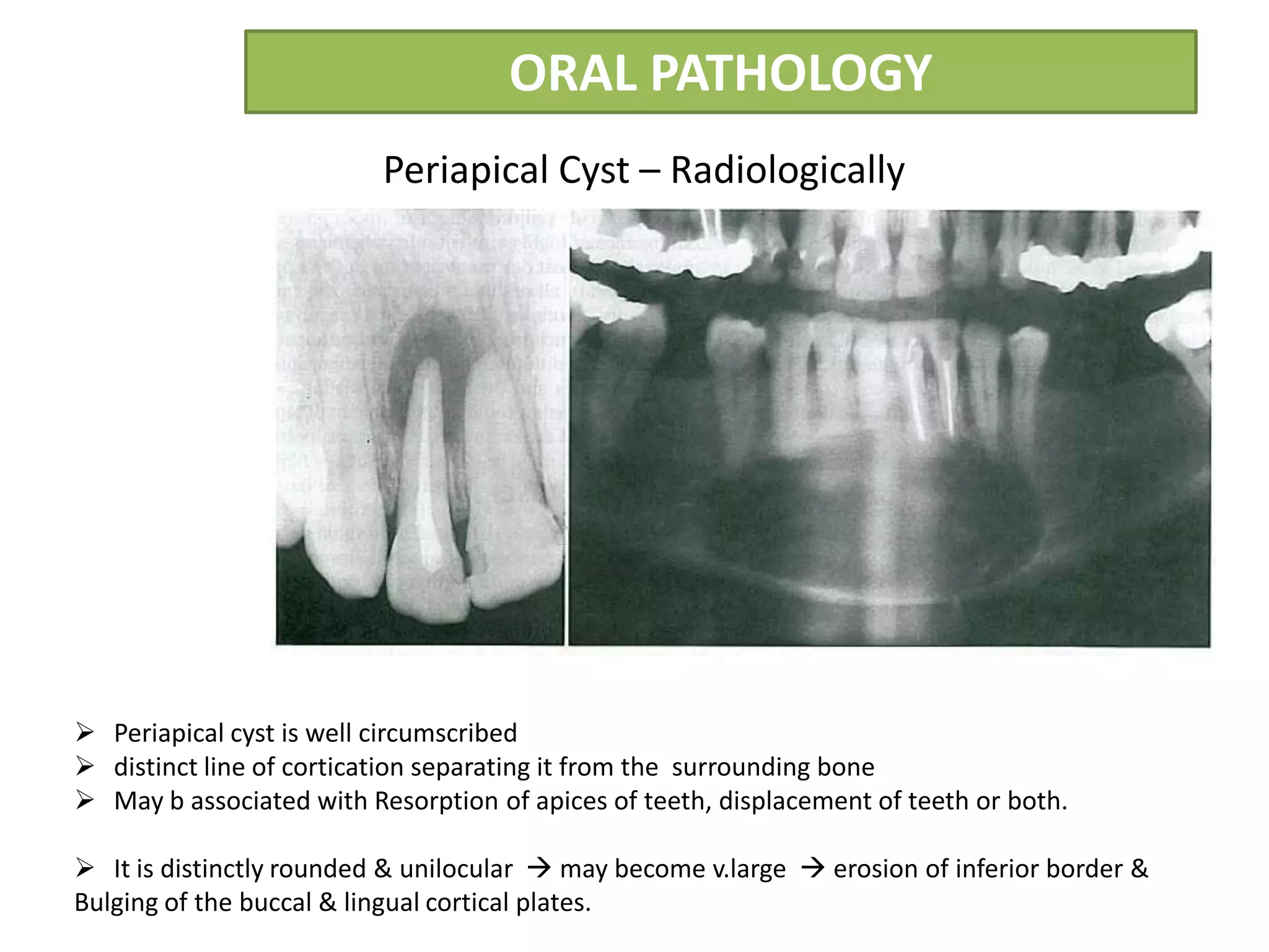 Radicular cyst or Periapical cyst | PPTX