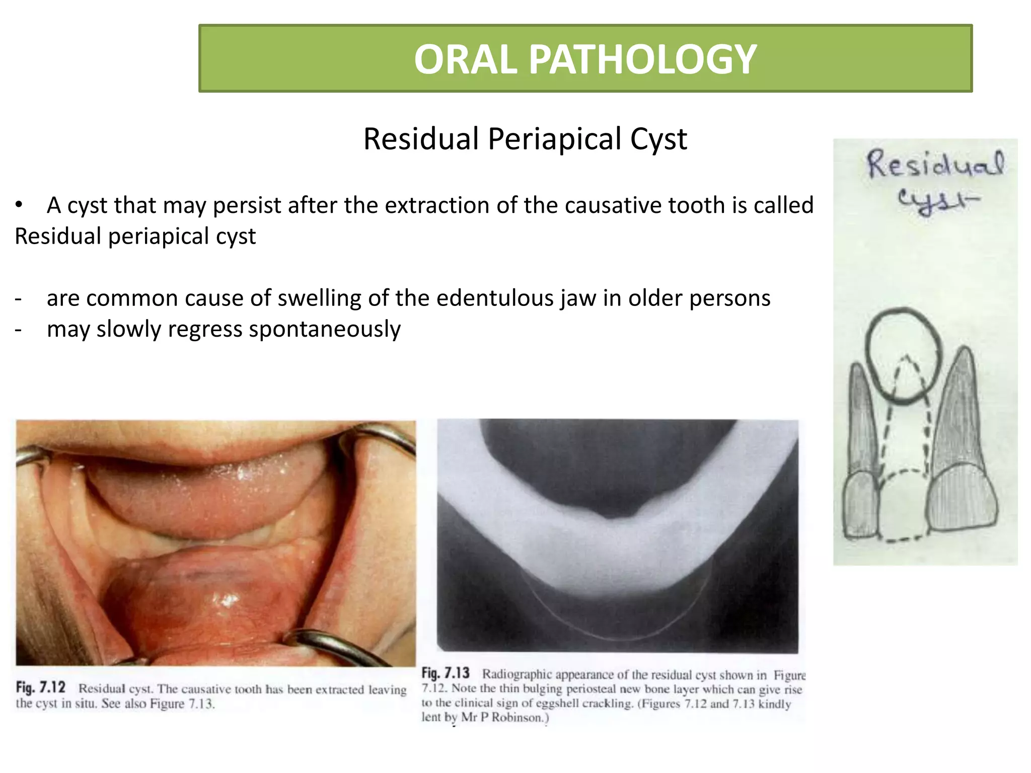 Radicular cyst or Periapical cyst | PPTX