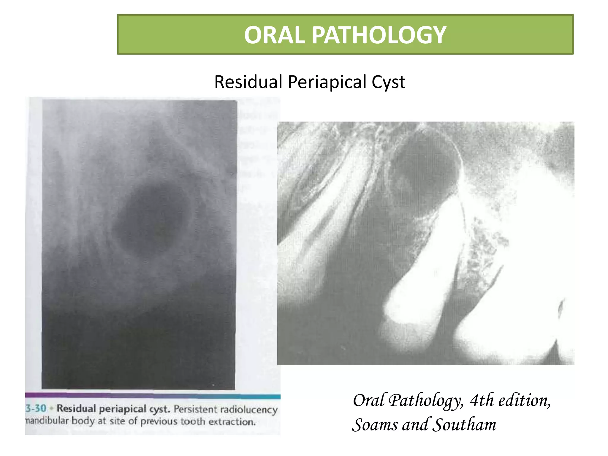 Radicular cyst or Periapical cyst | PPTX