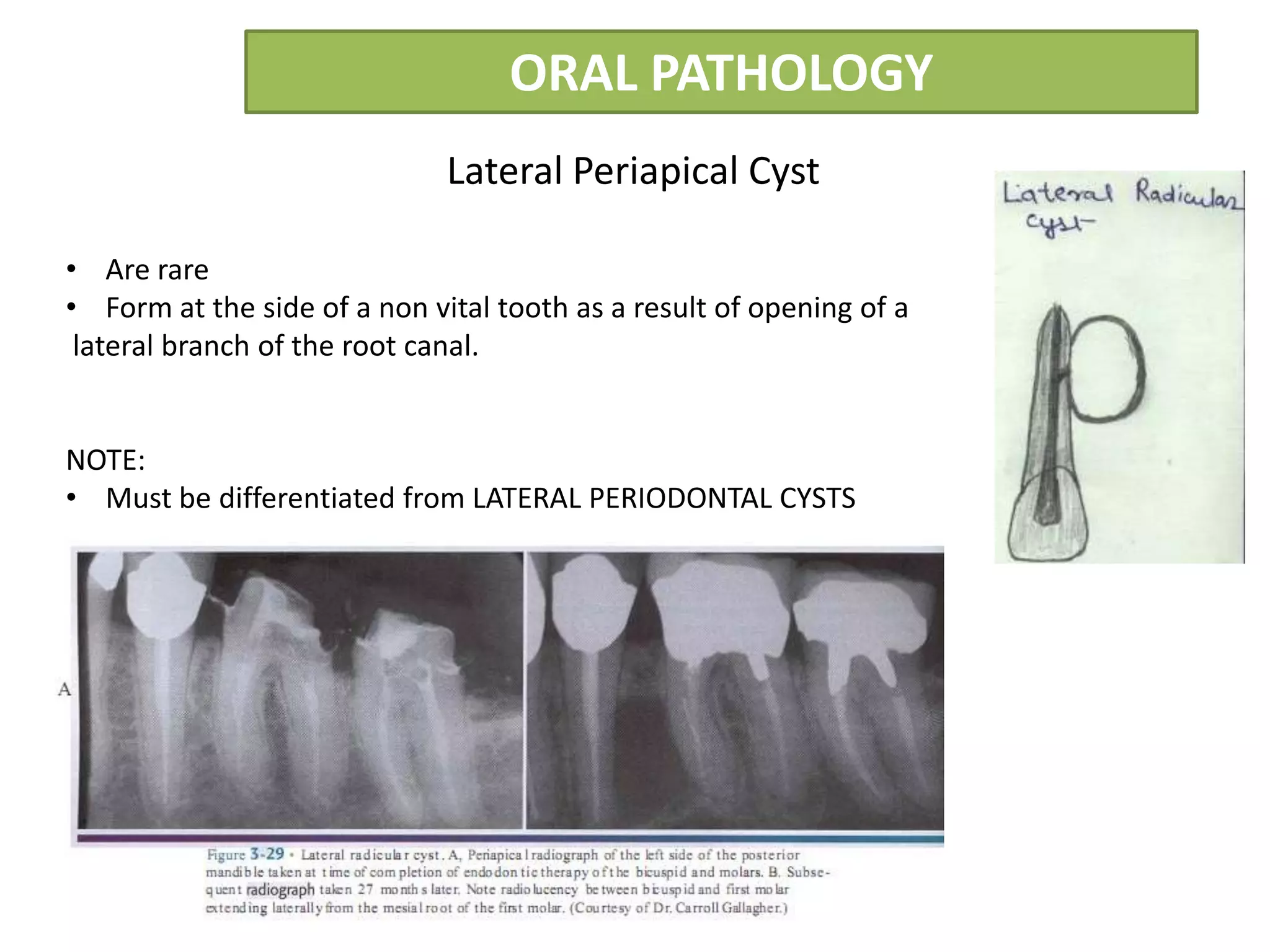 Radicular cyst or Periapical cyst | PPTX