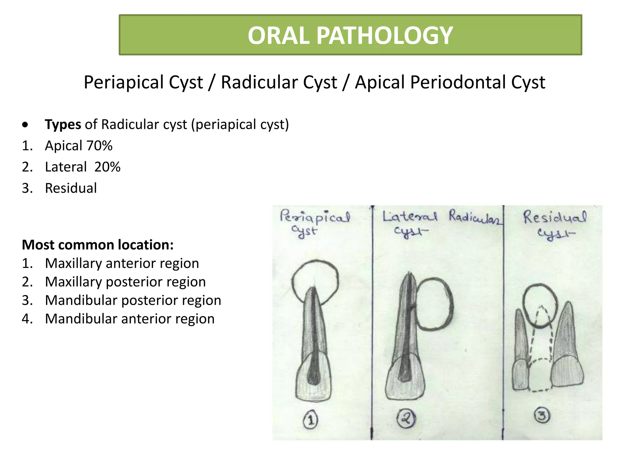 Radicular cyst or Periapical cyst | PPTX