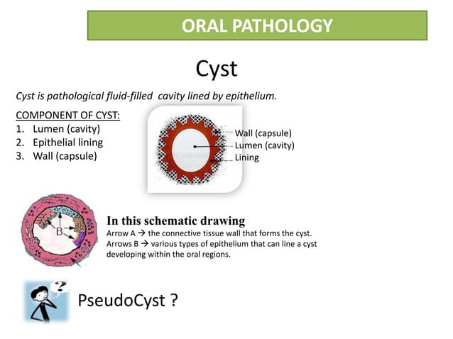 Radicular cyst or Periapical cyst | PPTX